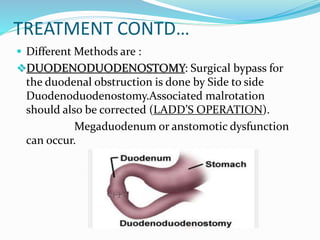duodenal atresia | PPTX