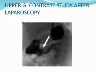duodenal atresia | PPTX
