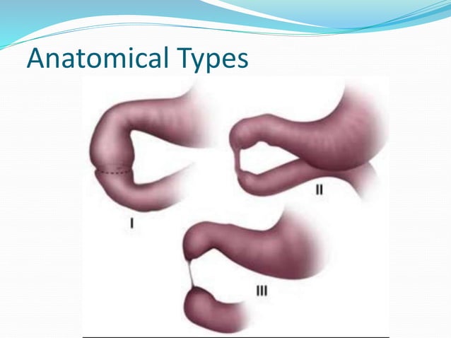 duodenal atresia