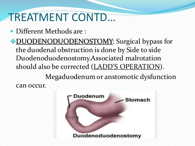 duodenal atresia