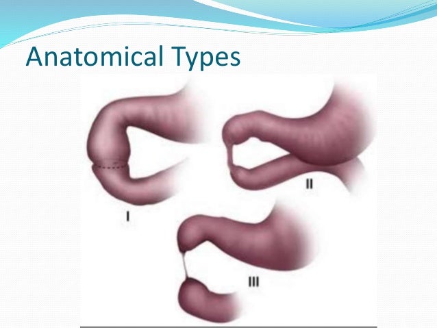duodenal atresia