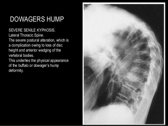 metabolic bone disorders