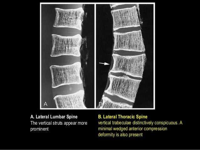 metabolic bone disorders