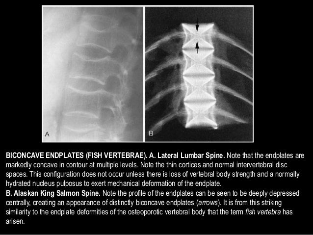 metabolic bone disorders