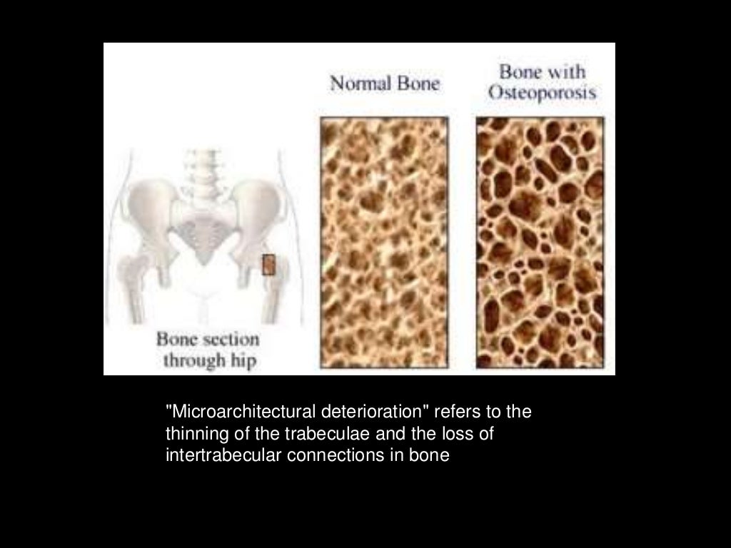 metabolic bone disorders