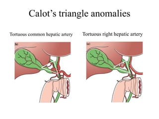 acute biliary infections | PPTX