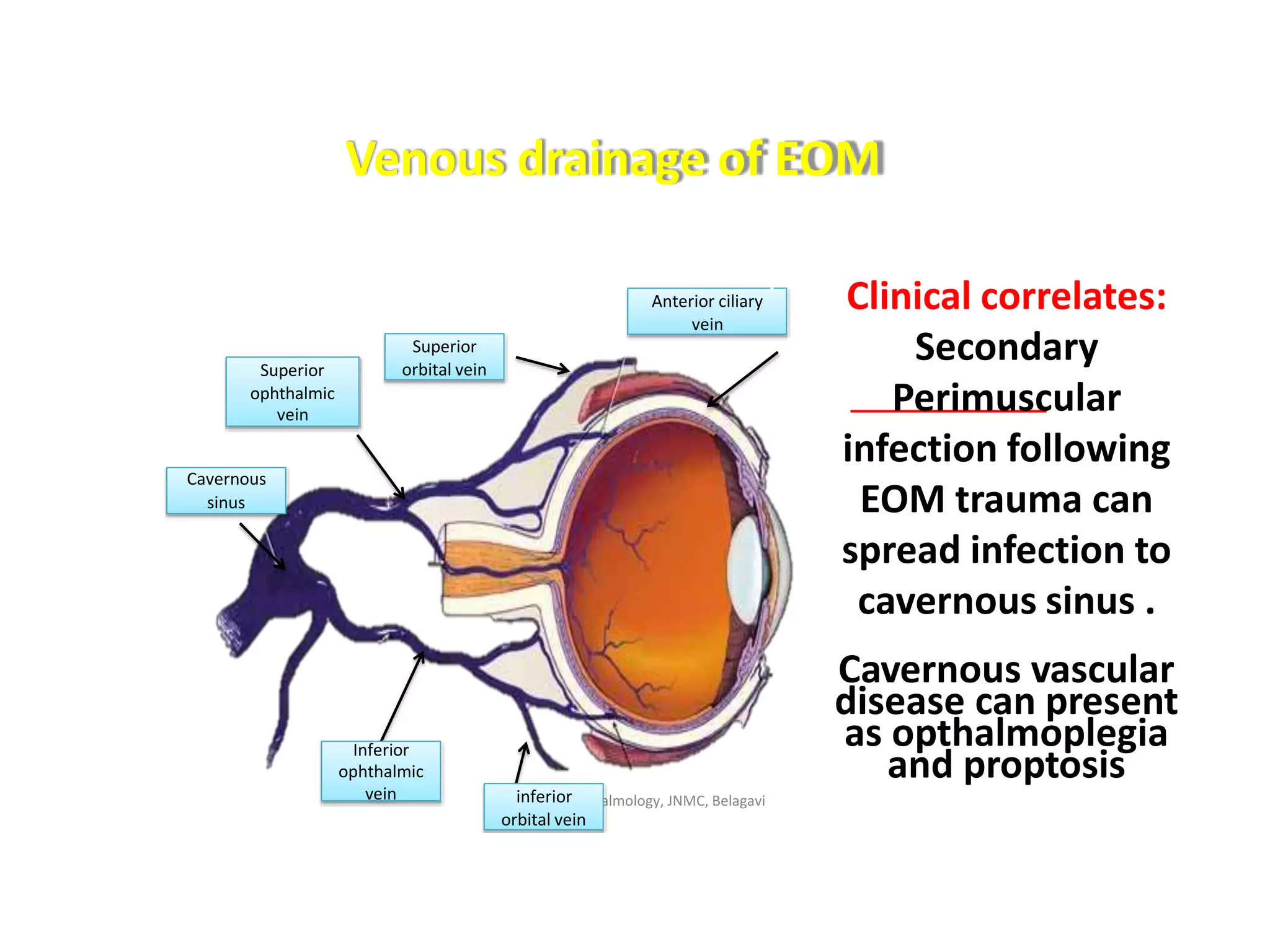 strabismus | PPTX