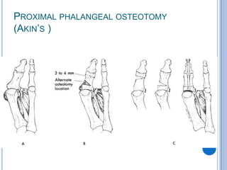 Hallux valgus | PPT