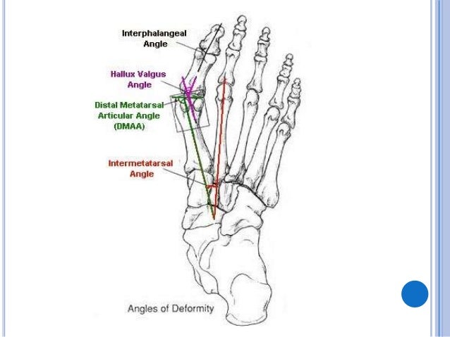 Hallux valgus