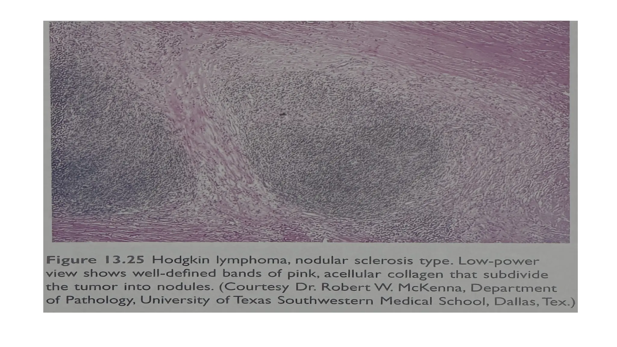 seminar Hodgkins lymjbibiobkgnnphomas.pptx