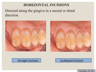 Instruments , incisons and basics of flap design for periodontal ...