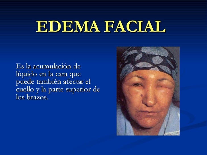 Seminario De Edema