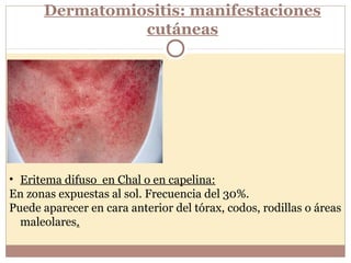dermatomiositis-Servicio de Clinica Medica-Sanatorio Parque | PPT