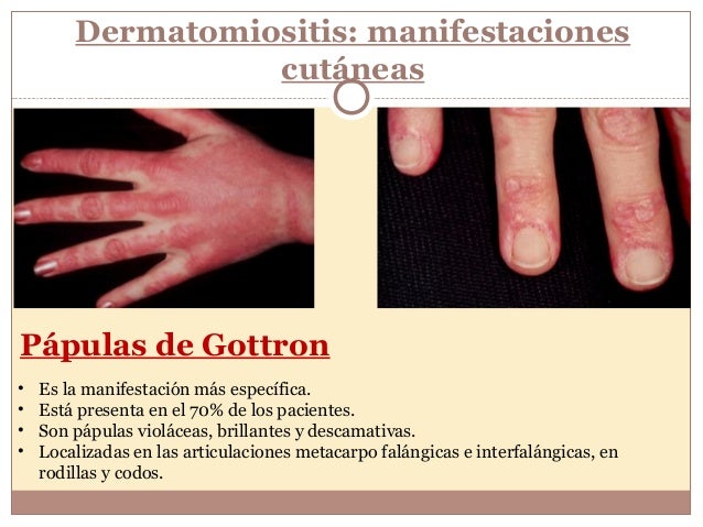 dermatomiositis-Servicio de Clinica Medica-Sanatorio Parque