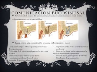 Proyección de resto radicular al seno maxilar | PPTX