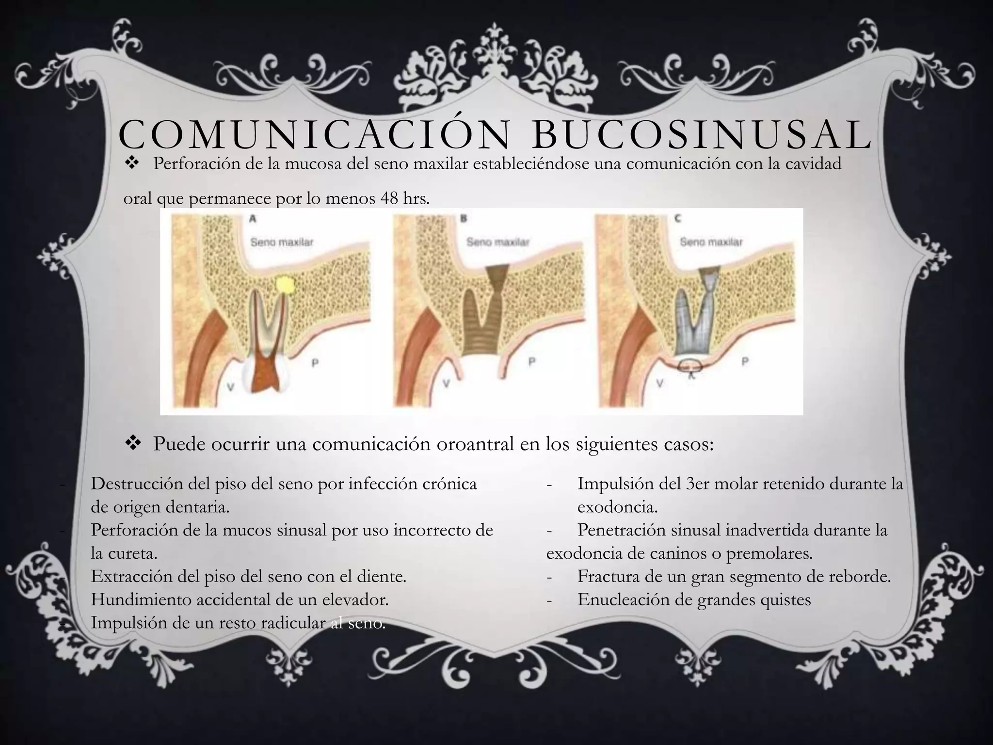 Proyección de resto radicular al seno maxilar | PPTX