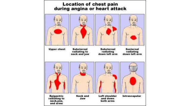 Cardiopatía Isquémica