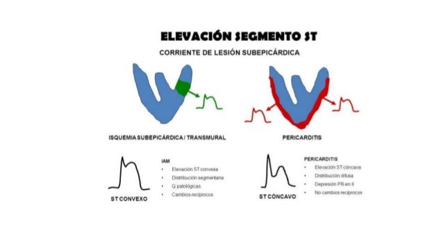 Infarto Agudo de Miocardio