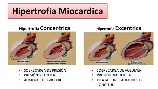Insuficiencia Cardiaca Congestica (ICC)