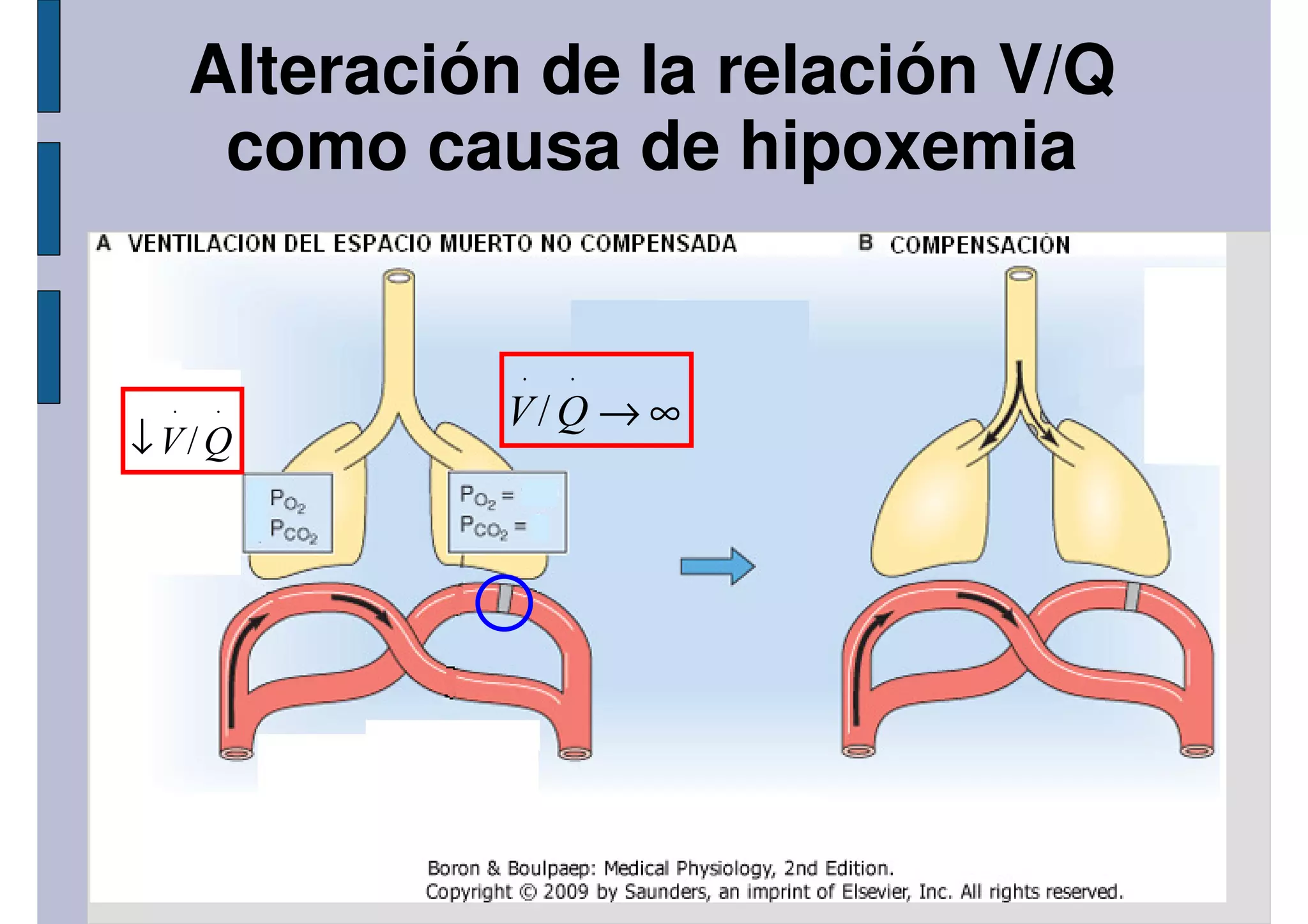 04 Rrelacion Ventilacion Perfusion V Q Pdf