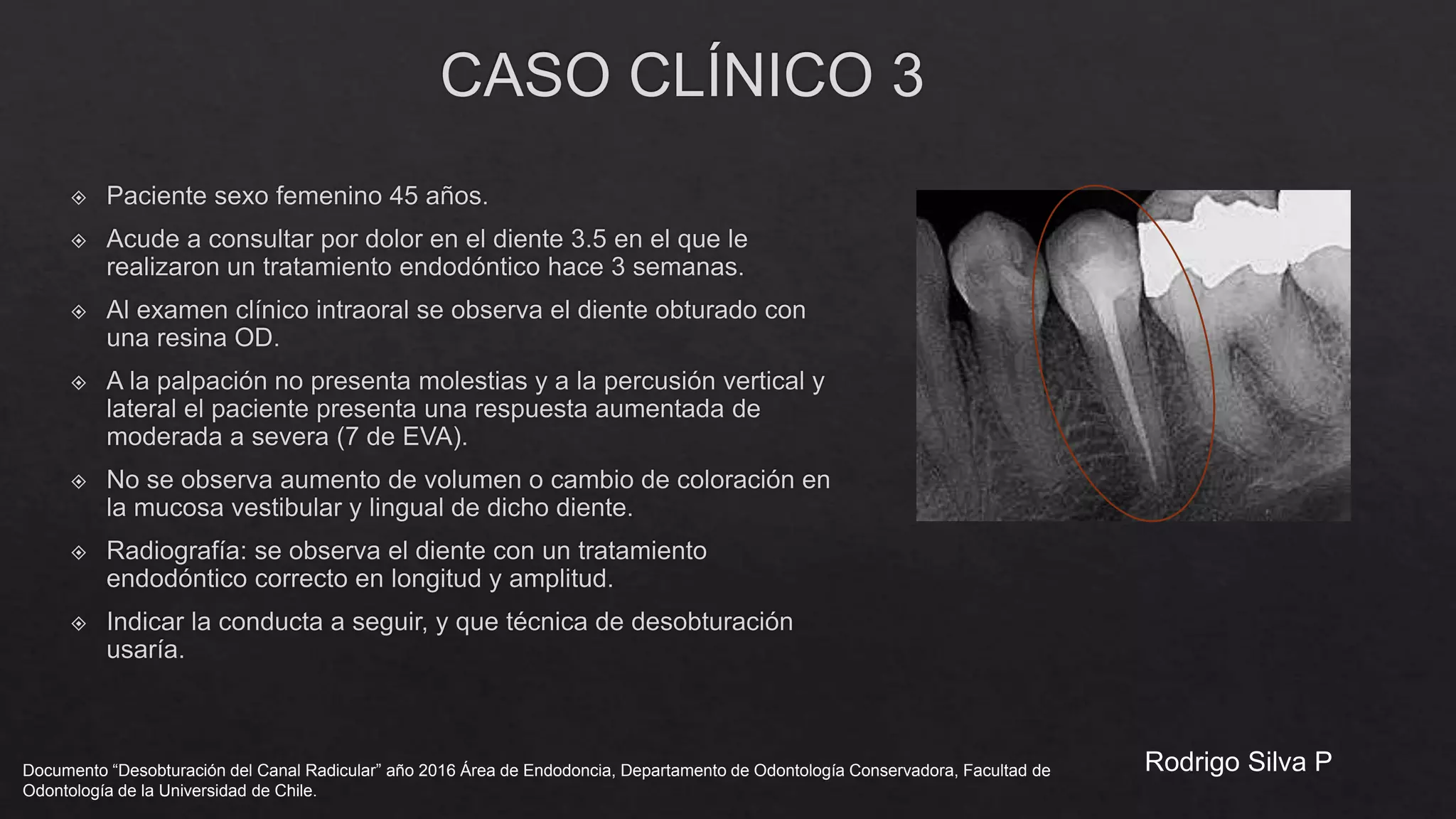 Seminario 9 desobturación de canal radicular | PPT