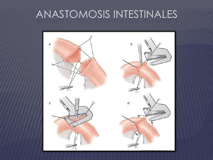 Seminario anastomosis intestinales