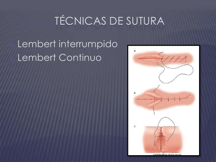 Seminario anastomosis intestinales