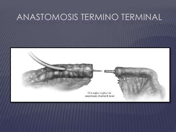 Seminario anastomosis intestinales