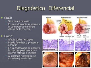 Colitis Ulcerativa Cronica Inespecifica (CUCI)