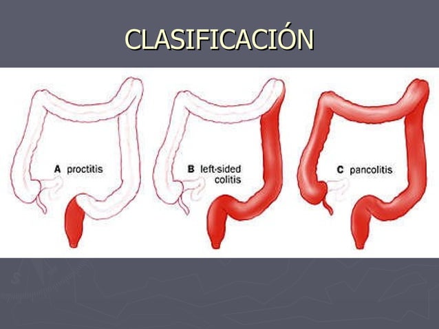 Colitis Ulcerativa Cronica Inespecifica (CUCI)