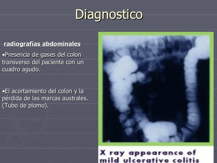 Colitis Ulcerativa Cronica Inespecifica (CUCI)