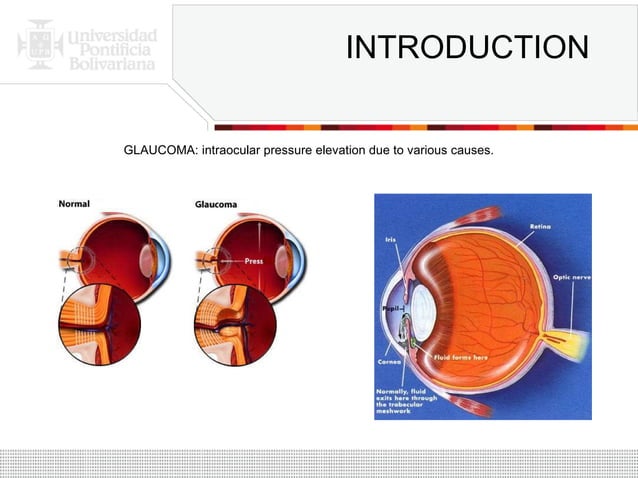 glaucoma | PPT