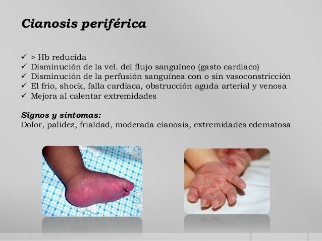 Seminario de cianosis