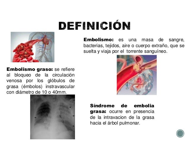 Embolismo Graso