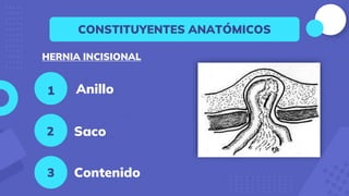 SEMINARIO DE EVENTRACION Y EVISCERACION.pptx