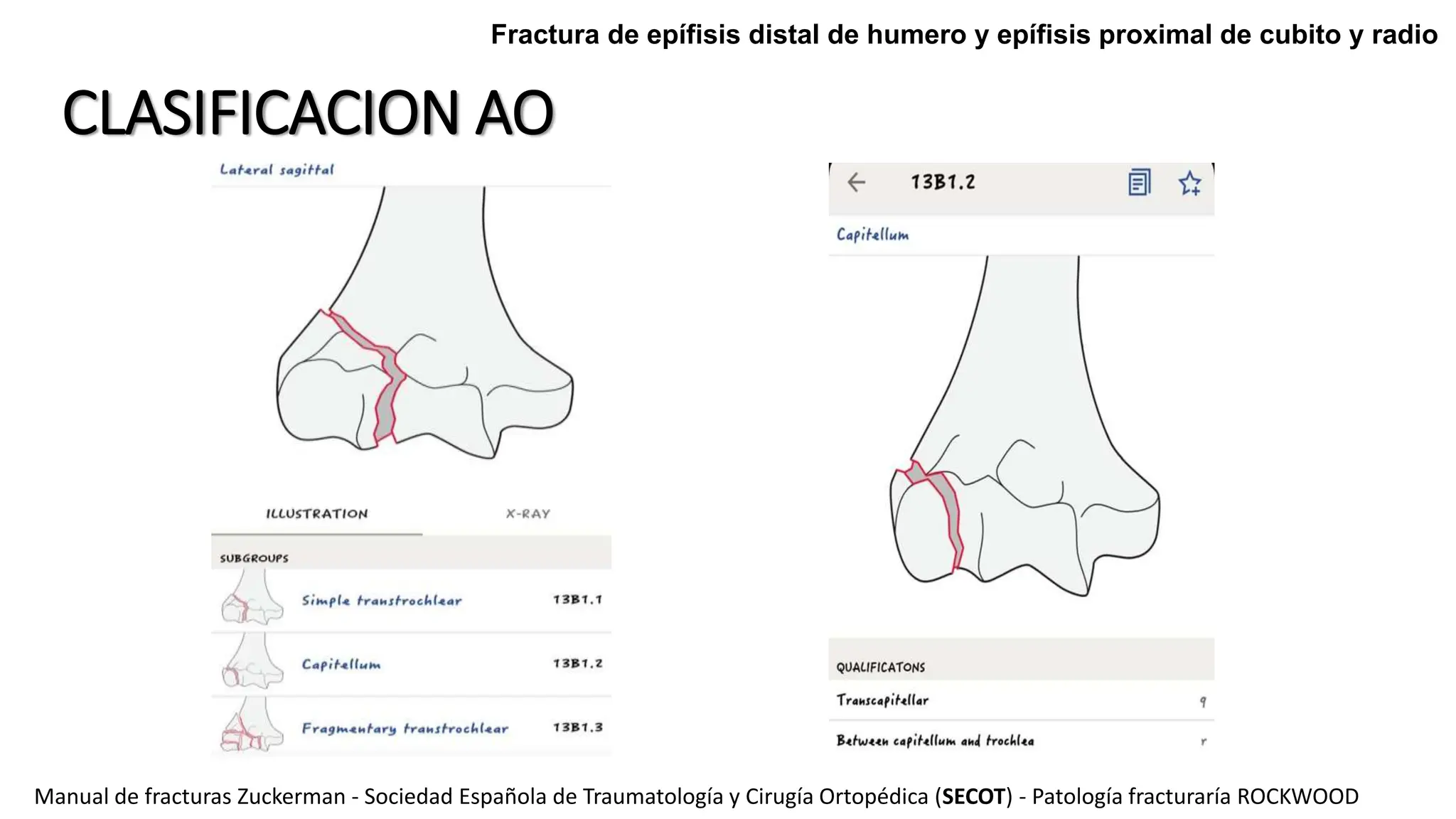 seminario de fracturas de humero dista.pptx