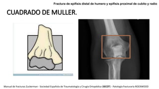 seminario de fracturas de humero dista.pptx
