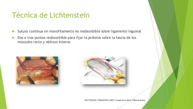 hernia inguinal y crural