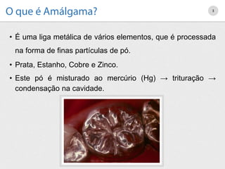 Amálgama Dental | PPT