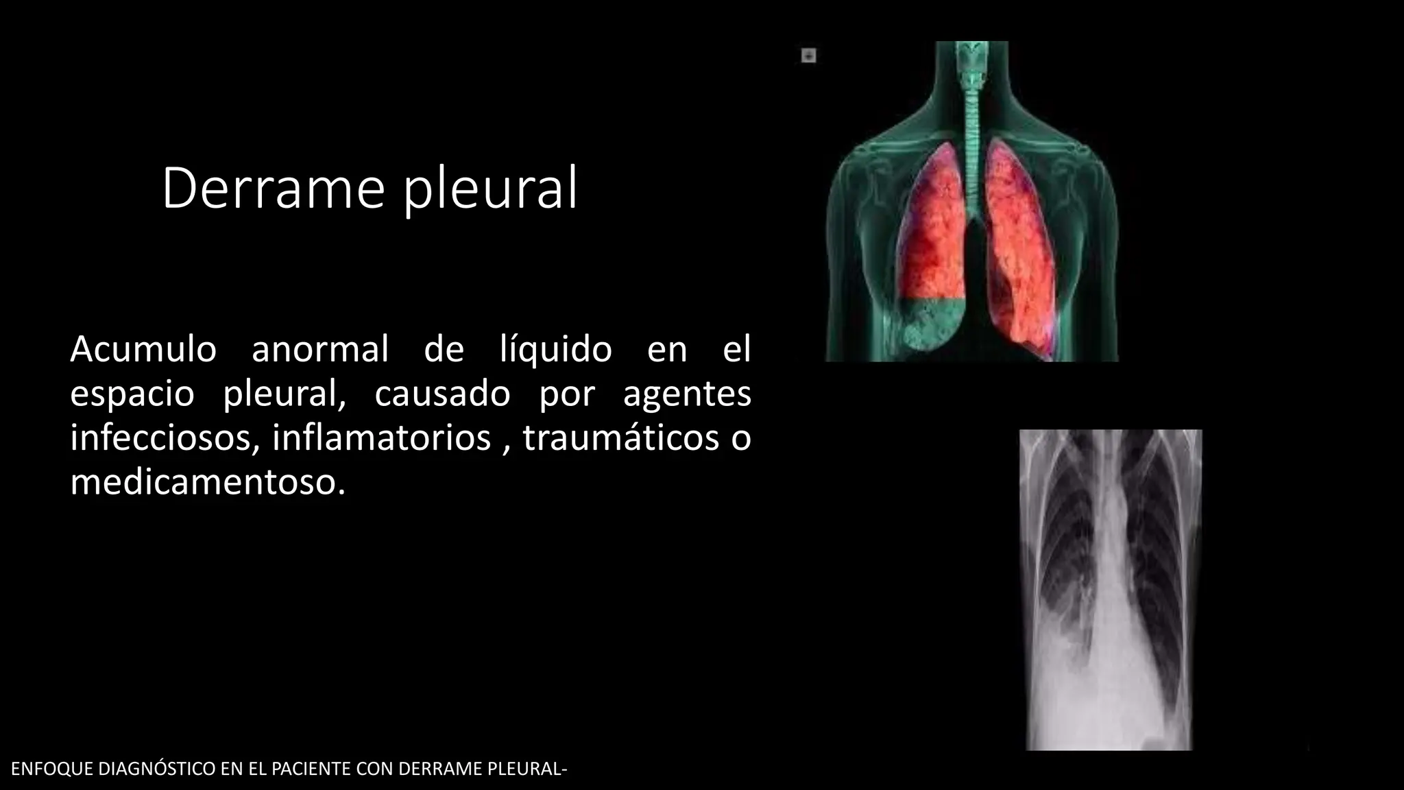 seminario de torax manejo del derrame pleural | PPT