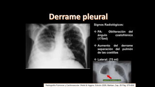 seminario de torax manejo del derrame pleural | PPTX