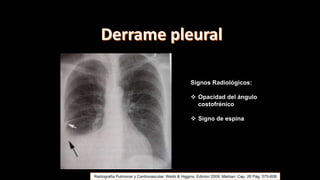 seminario de torax manejo del derrame pleural | PPTX