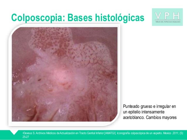 VPH (Virus del Papiloma Humano)