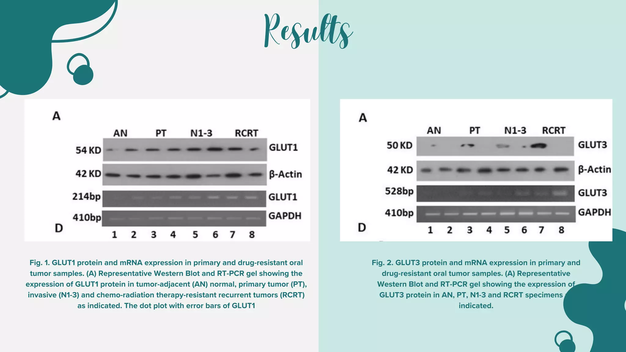 Role and regulation of GLUT1/3 during oral cancer progression and ...