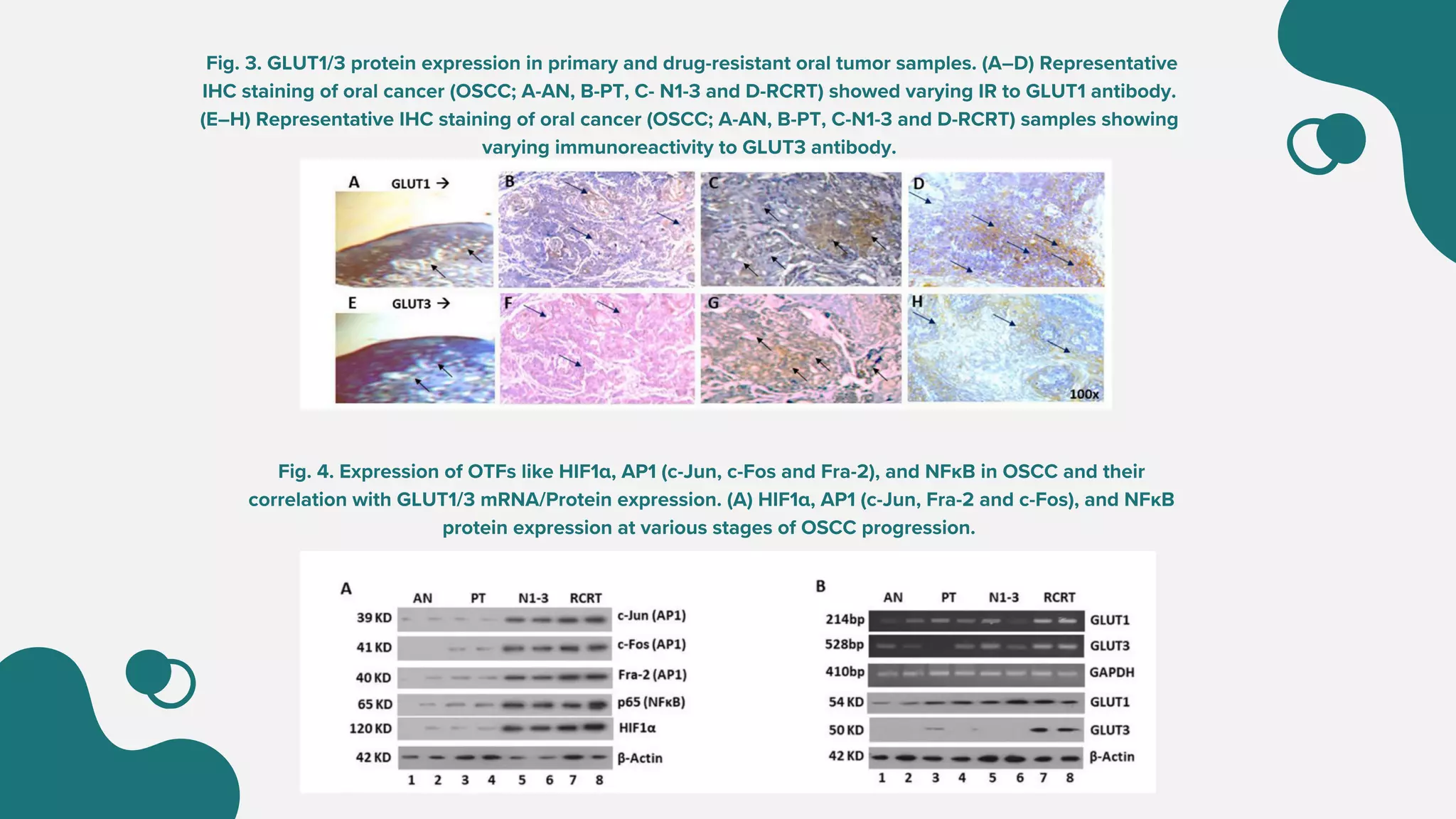 Role and regulation of GLUT1/3 during oral cancer progression and ...