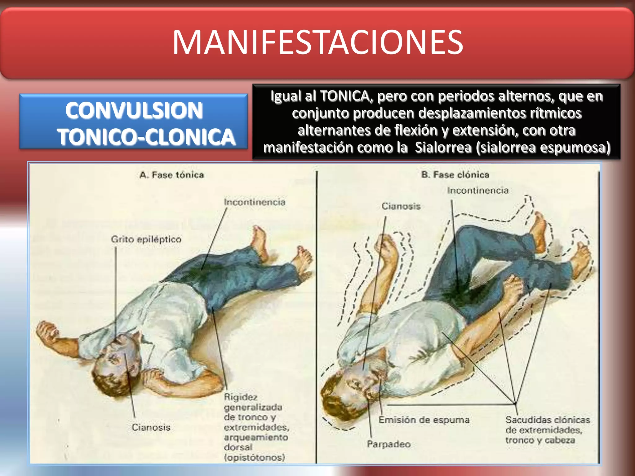 fisiopatologia convulsiones y epilepsias | PPTX