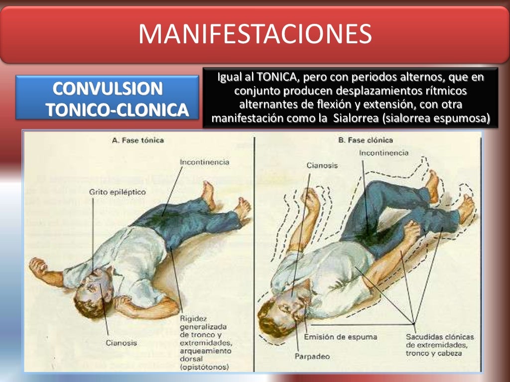 fisiopatologia convulsiones y epilepsias