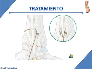 FRACTURAS DE TOBILLO | PPTX