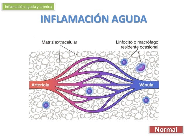 Inflamación Aguda y Crónica