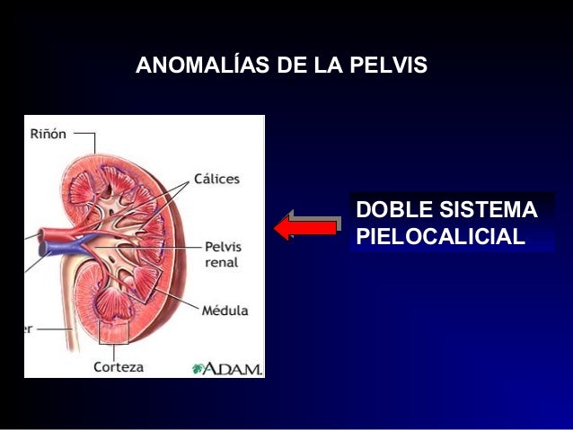 La Malformaciones renales en Imagenología